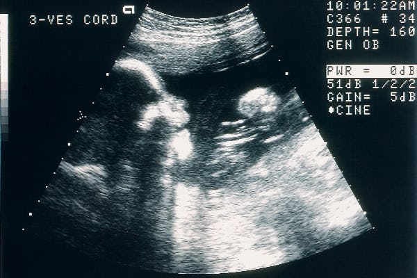 The Difference Between An Ultrasound & Sonogram, Explained