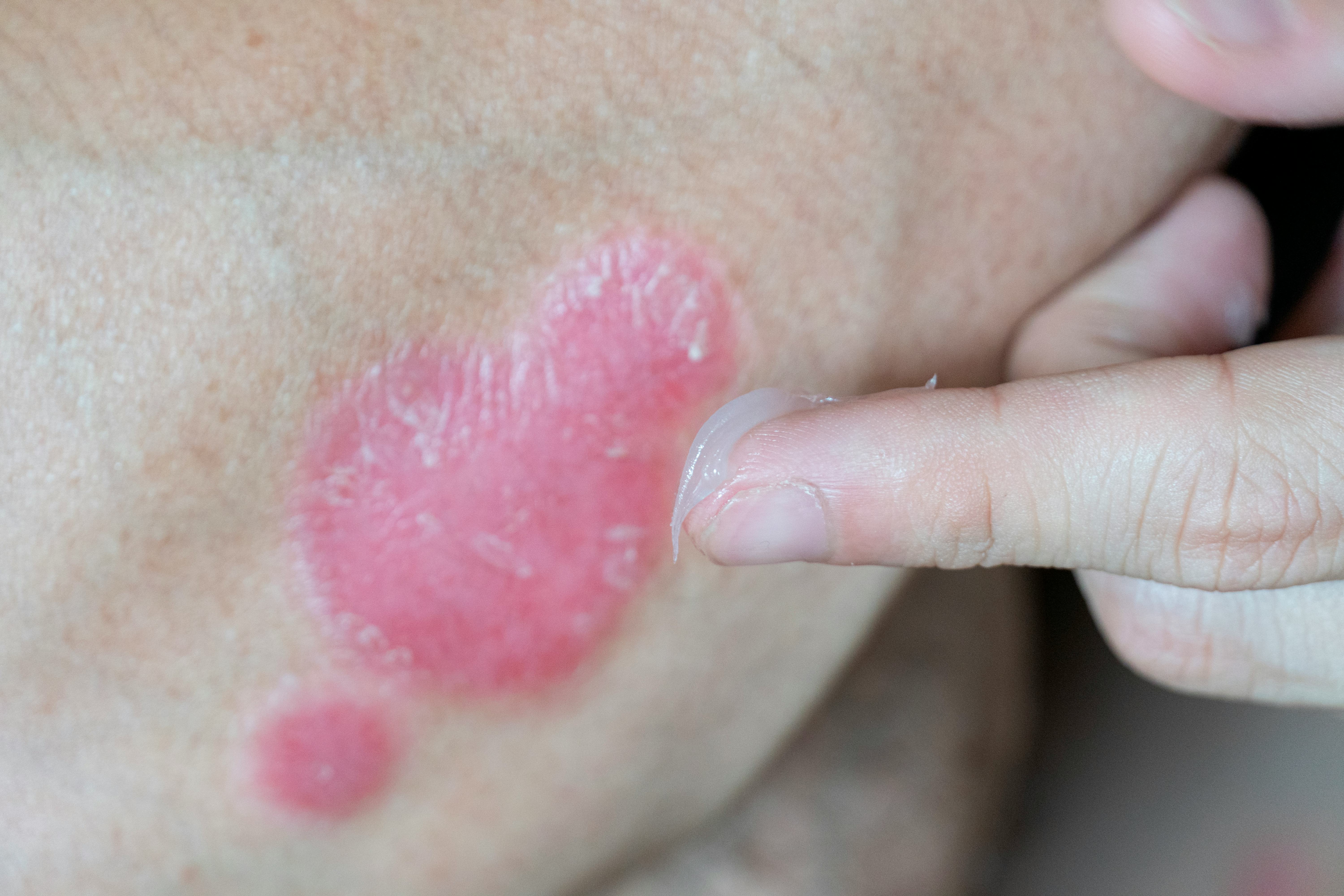 Inflammation: Immune system science explains why the body attacks itself