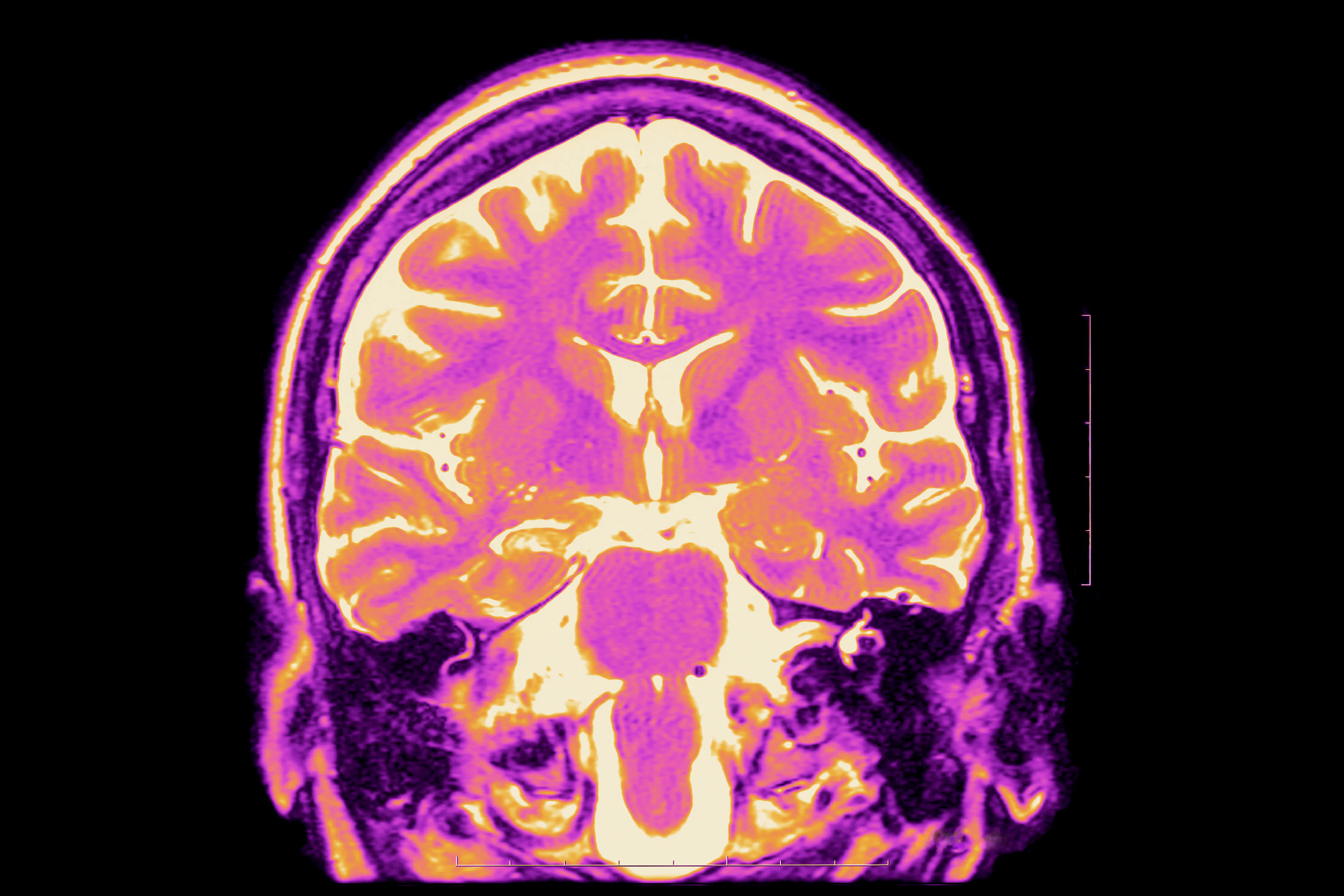 The brain’s memory hub may explain why some people get PTSD and some ...