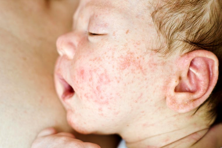 Baby Eczema: Causes, Treatments & When To Call The Doctor