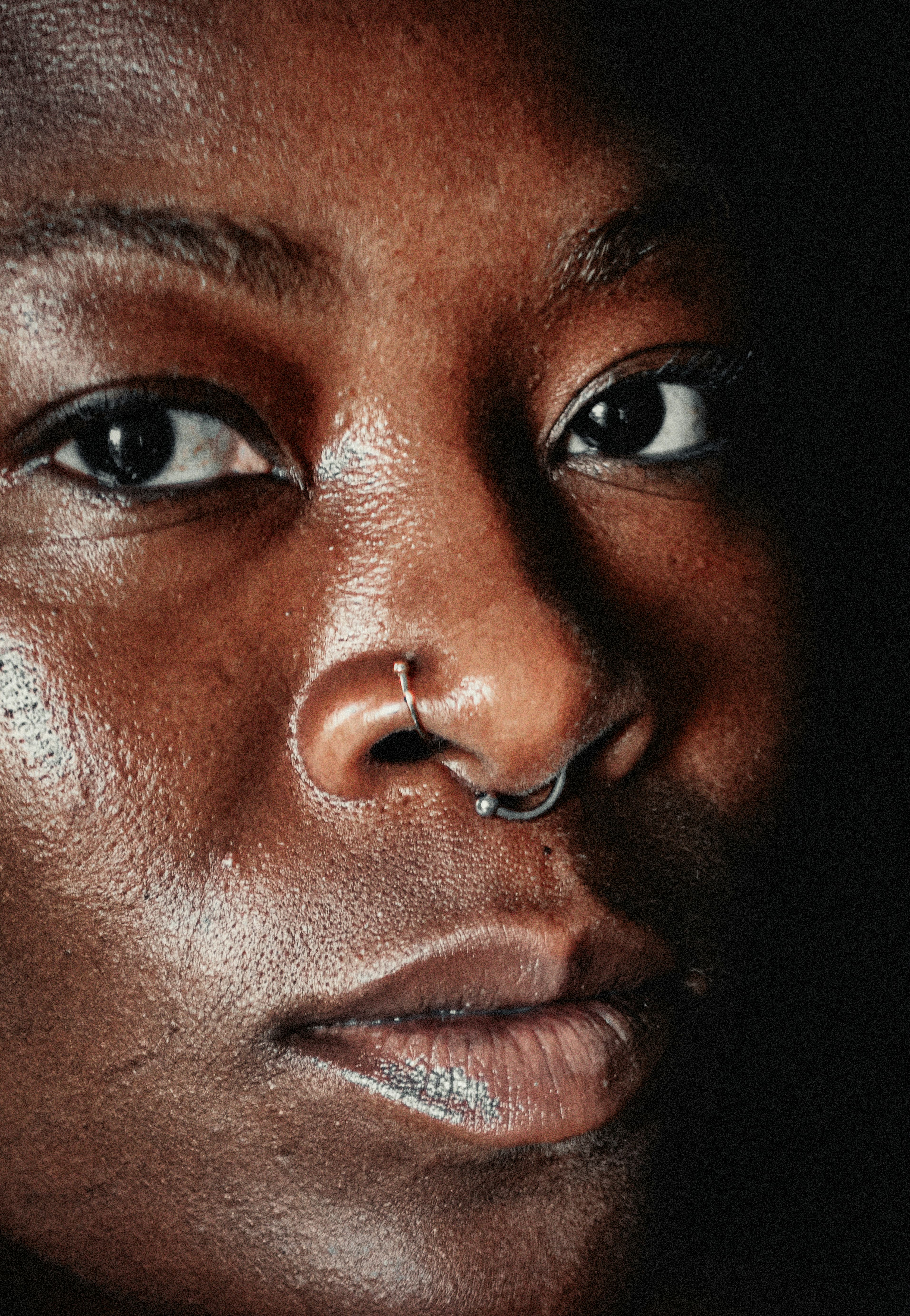 Fat Transfer For Under-Eyes: Is It A Better Option Than Under-Eye Filler?