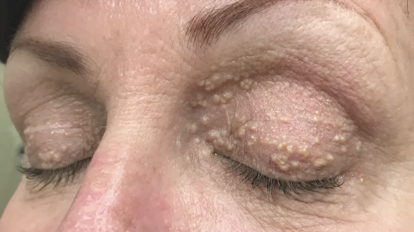 Dr. Pimple Popper's Eyelid Extraction Video Is Going Viral For Very ...