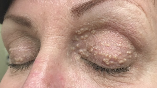 Dr. Pimple Popper's Eyelid Extraction Video Is Going Viral For Very ...