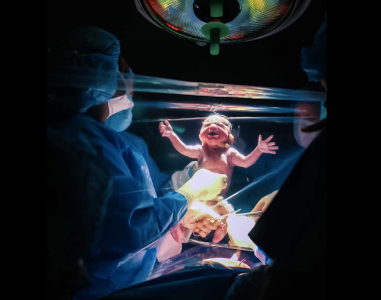 These Photos Of C-Sections That Use Clear Plastic Drapes Are Breathtaking