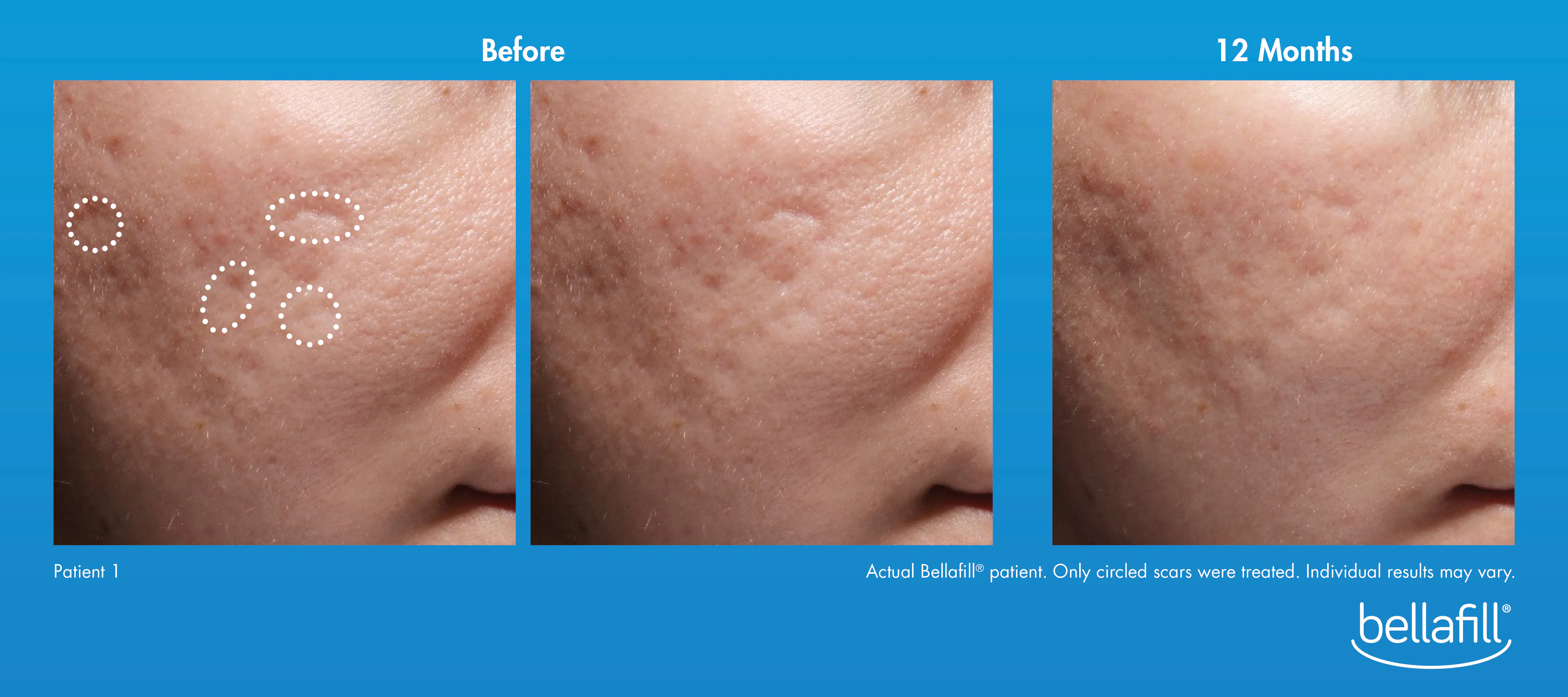 How To Get Rid Of Acne Scars For Good With Bellafill