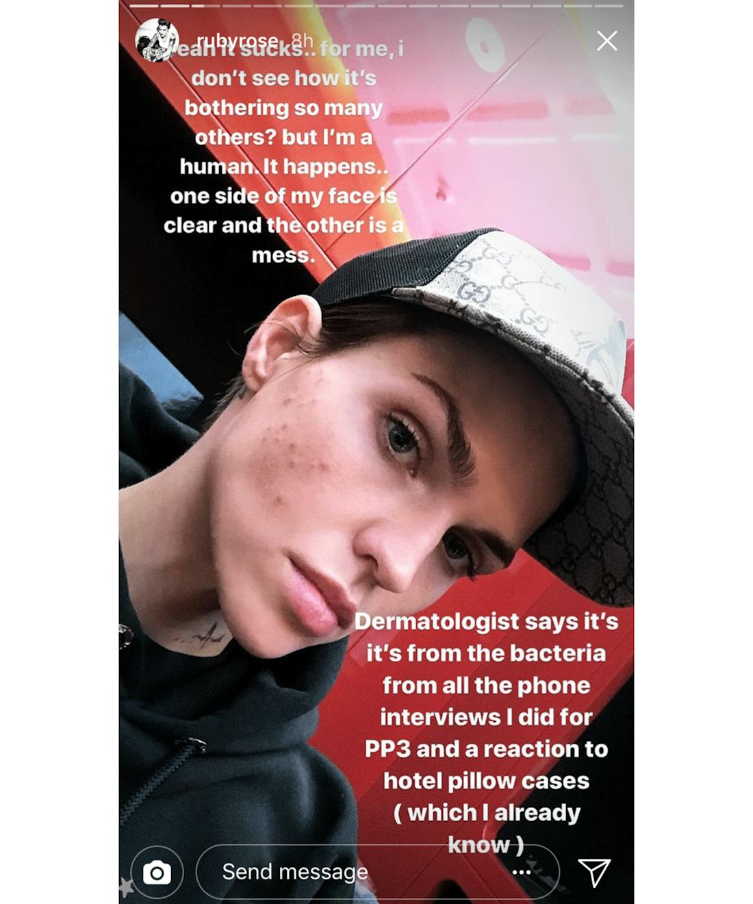 Ruby Rose’s Struggle With Acne Is Seriously Relatable