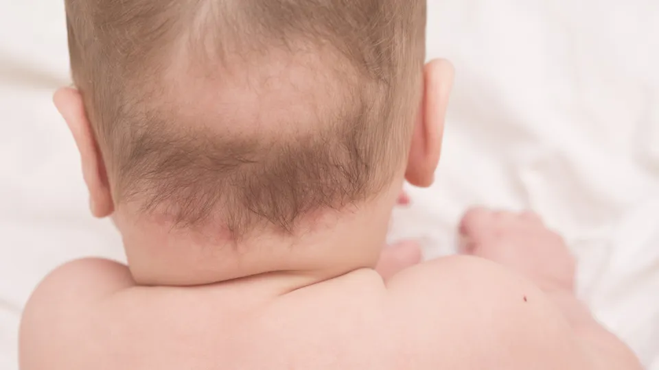 Why Does My Baby Have A Bald Spot On The Back Of Their Head It s A Why Does My Baby Have A Bald Spot On The Back Of Their Head It s A