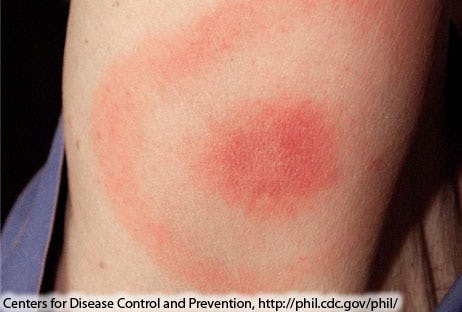 What Does Lyme Disease Look Like In A Toddler? Experts Describe The ...