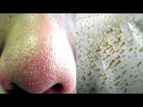 Pimple Popping Videos & 14 Other Gross Things People Are Obsessed With