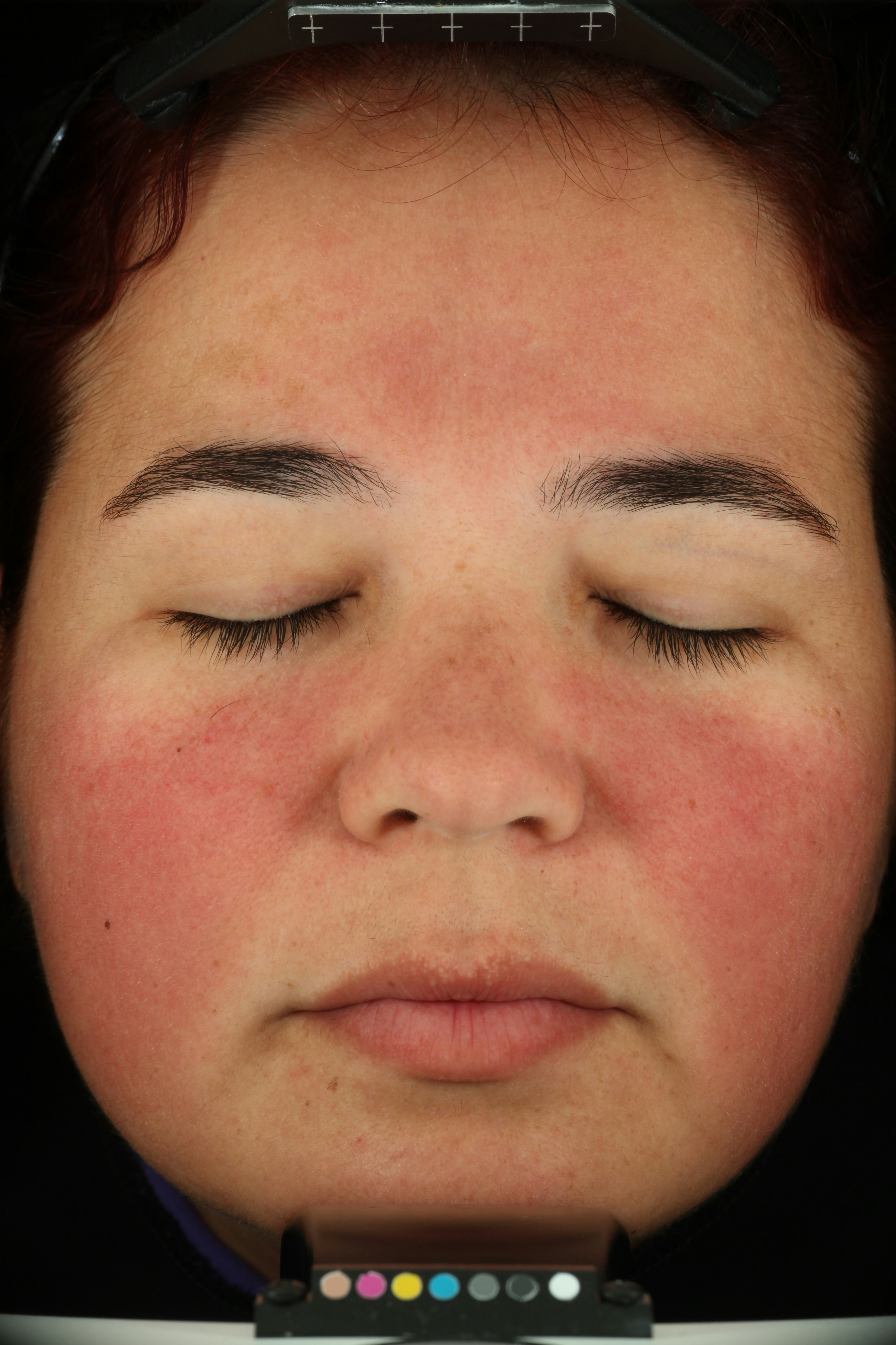 When Is Acne Not Acne? These 3 Skin Conditions Are Often Mistaken For A ...