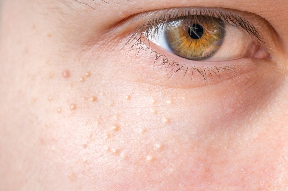 When Is Acne Not Acne? These 3 Skin Conditions Are Often Mistaken For A ...