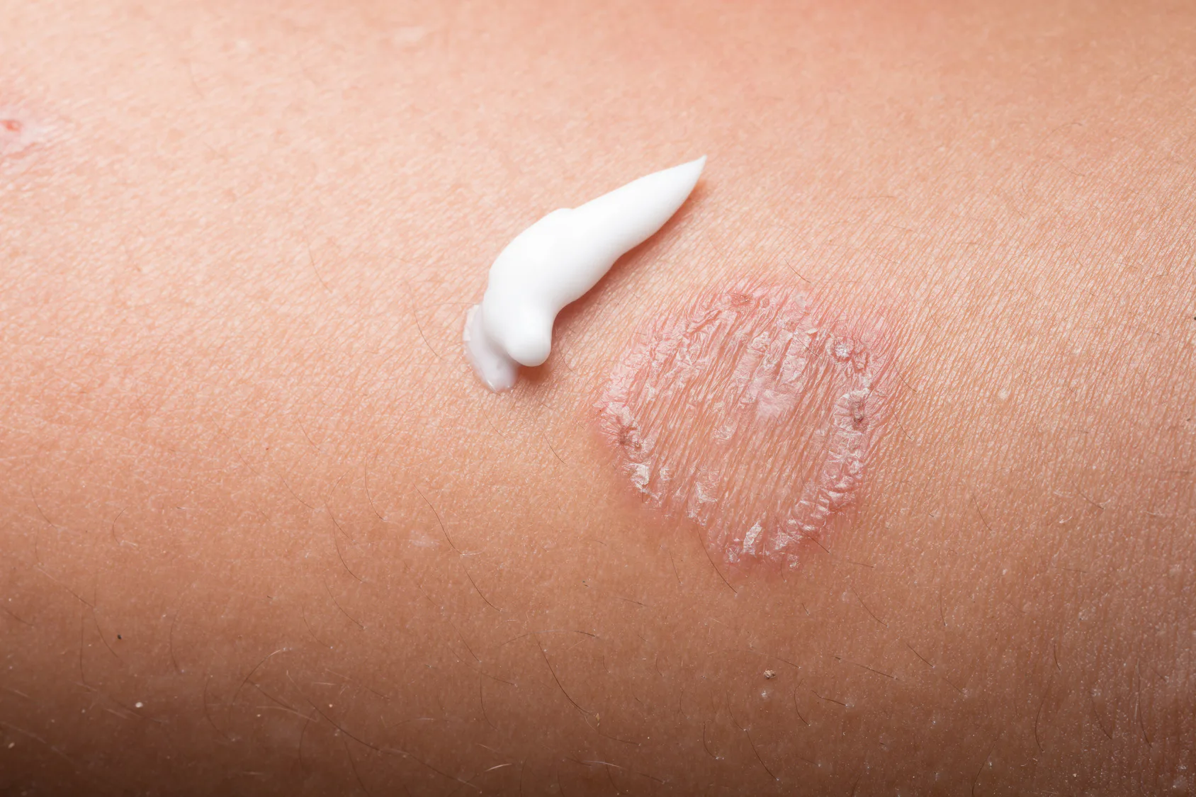 How To Treat A Baby Rash, According To Experts
