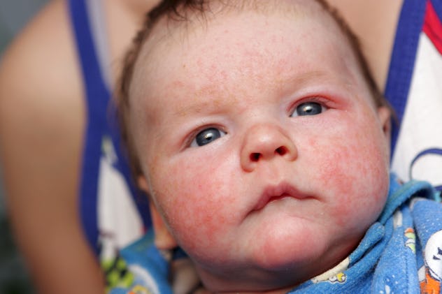 How To Treat A Baby Rash, According To Experts