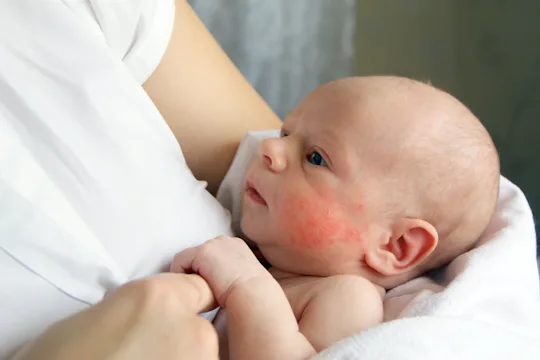 How To Treat A Baby Rash According To Experts How To Treat A Baby Rash According To Experts