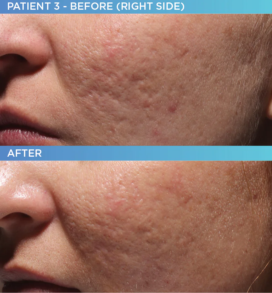 How To Get Rid Of Acne Scars For Good With Bellafill