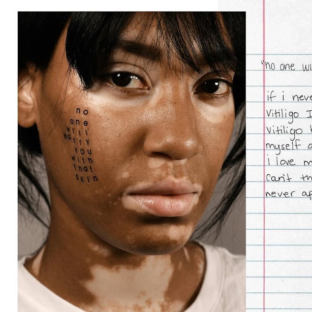 This Photo Series Celebrates Visible Skin Conditions & It's So Empowering