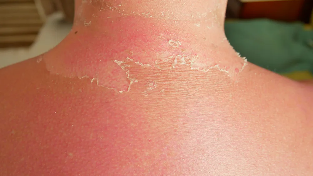 These Sunburn Horror Stories Will Remind You That SPF Is A Blessing