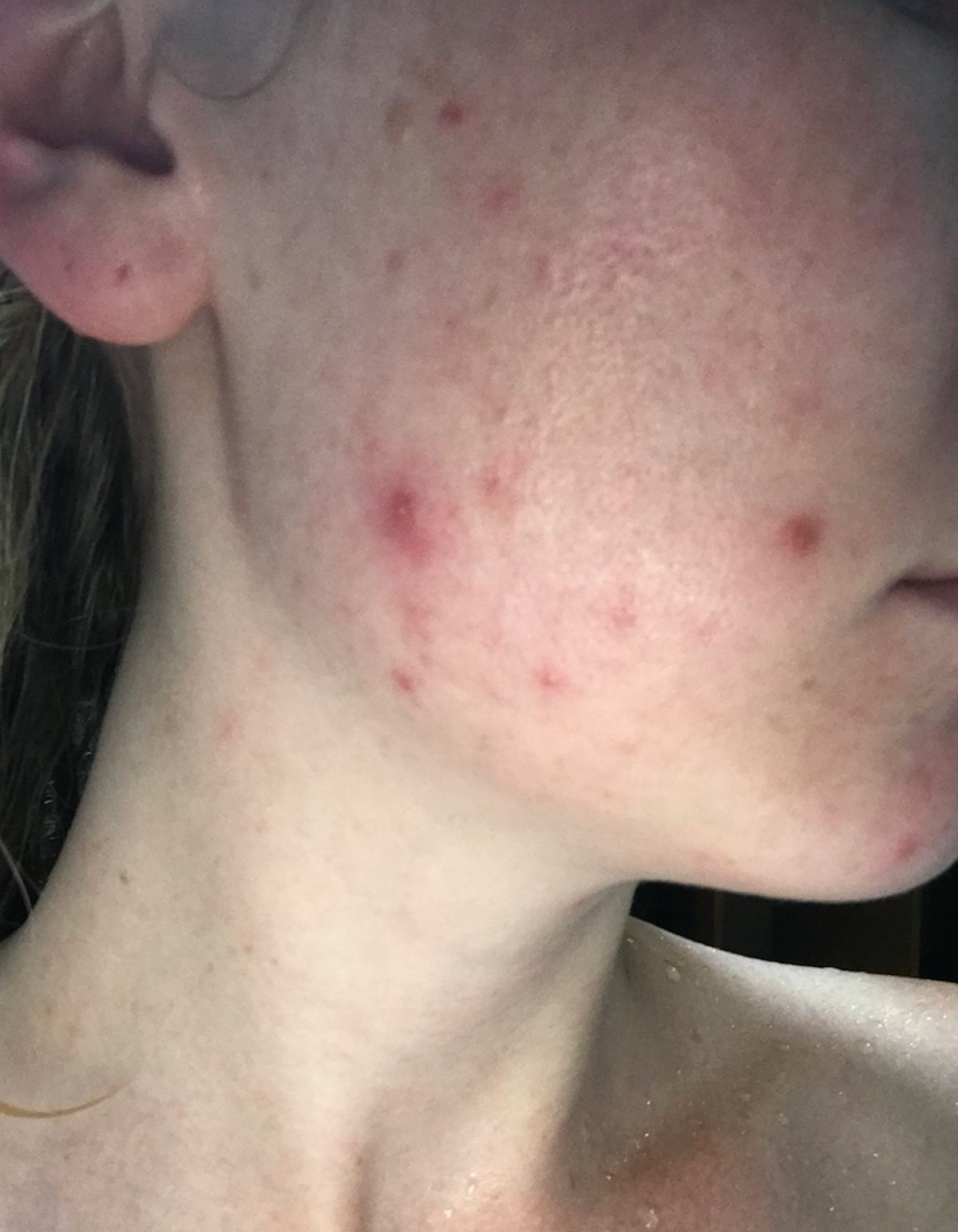 Retin A Cream Has Worked Actual Magic On My Acne-Prone Skin