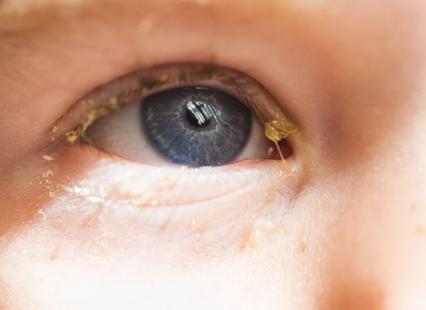 How Do Kids Get Pink Eye? It Comes From Exactly Where You Always ...