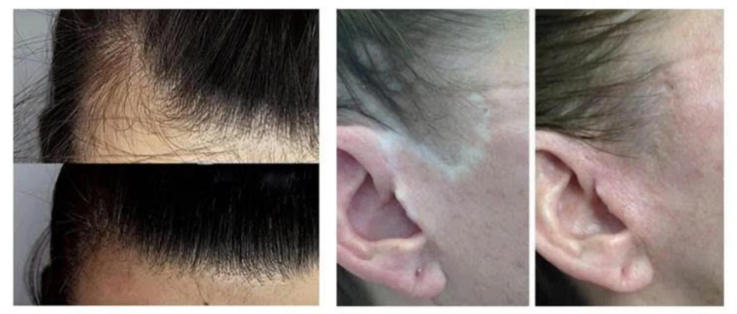 Scalp Micropigmentation Could Be The Future Of Hair Loss Solutions