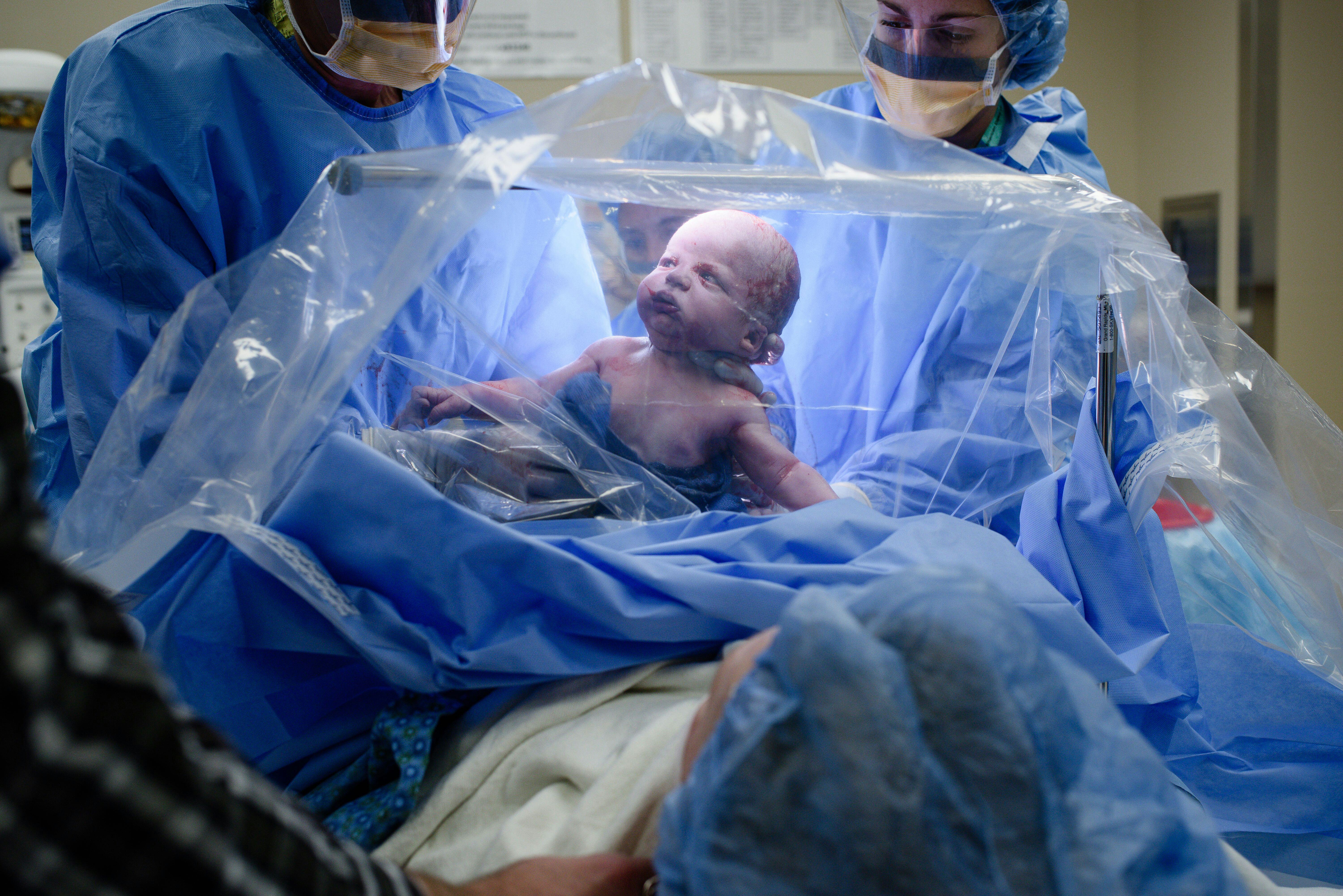 22 C-Section Birth Photos That Prove They're Just As Intense & Powerful ...