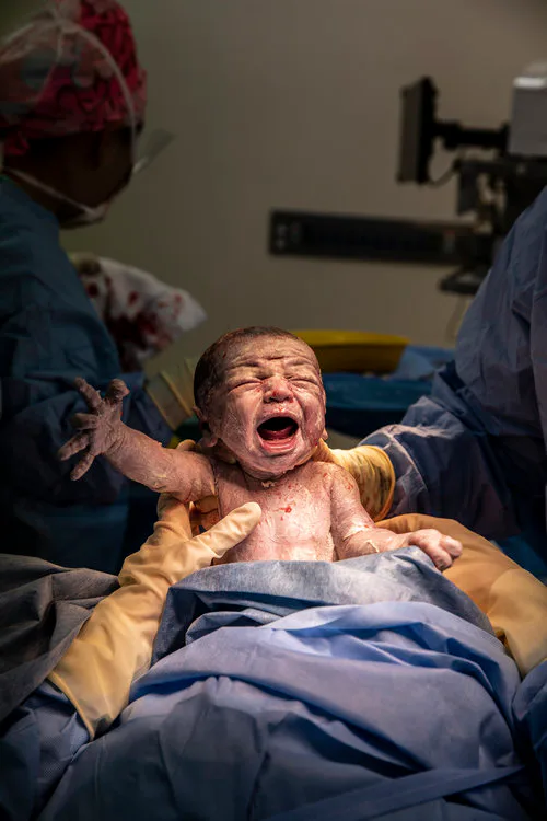 22 C-Section Birth Photos That Prove They're Just As Intense & Powerful ...