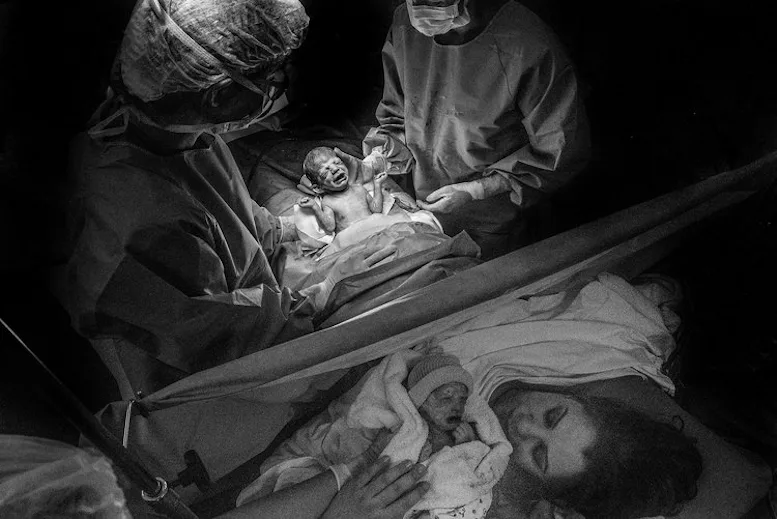 22 C-Section Birth Photos That Prove They're Just As Intense & Powerful ...