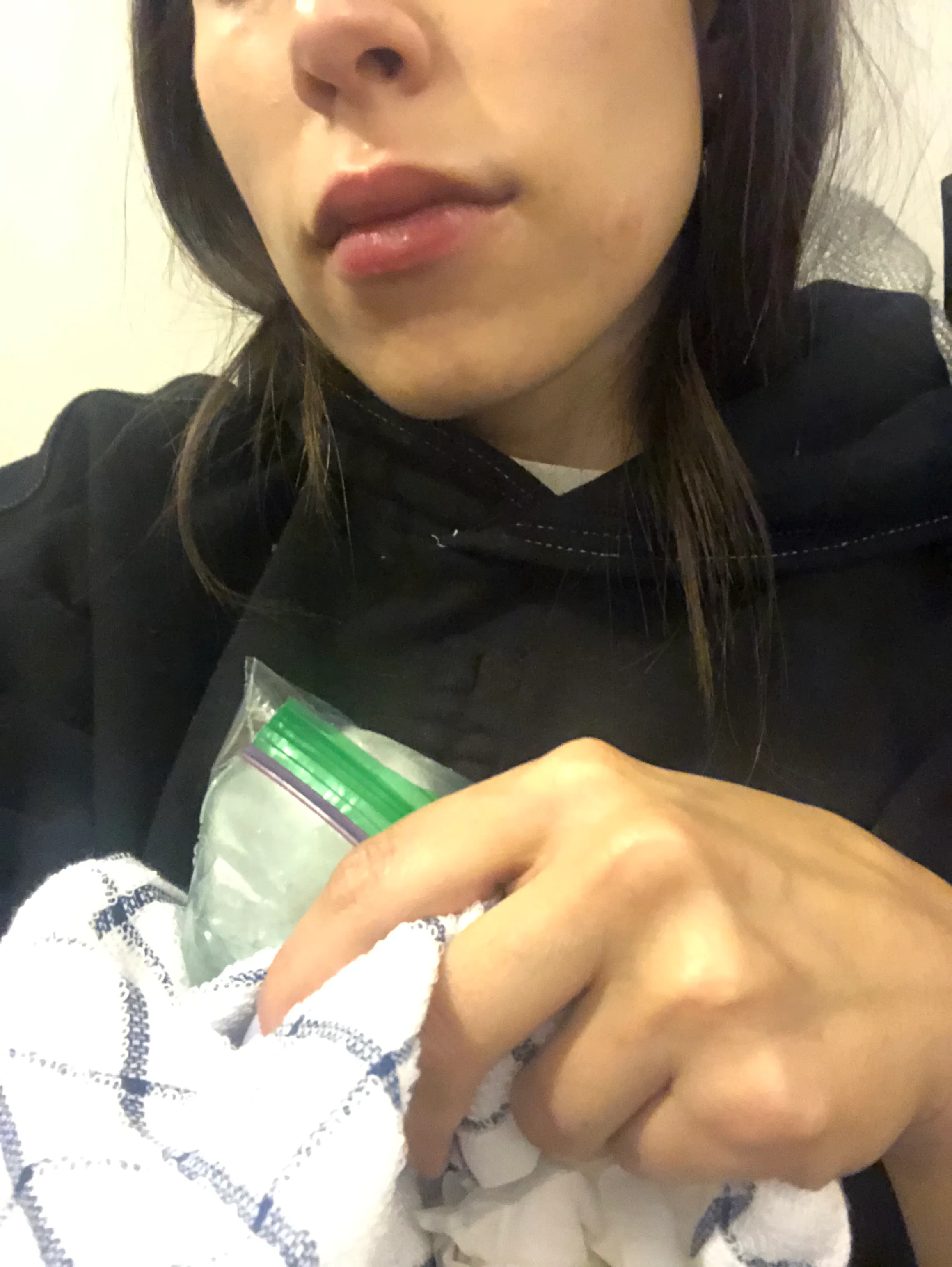 How Subtle Lip Injections Can Transform Your Entire Face