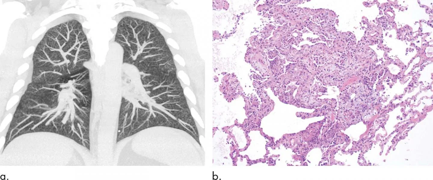 EVALI: Lung scans show how vape illness tears through the lungs
