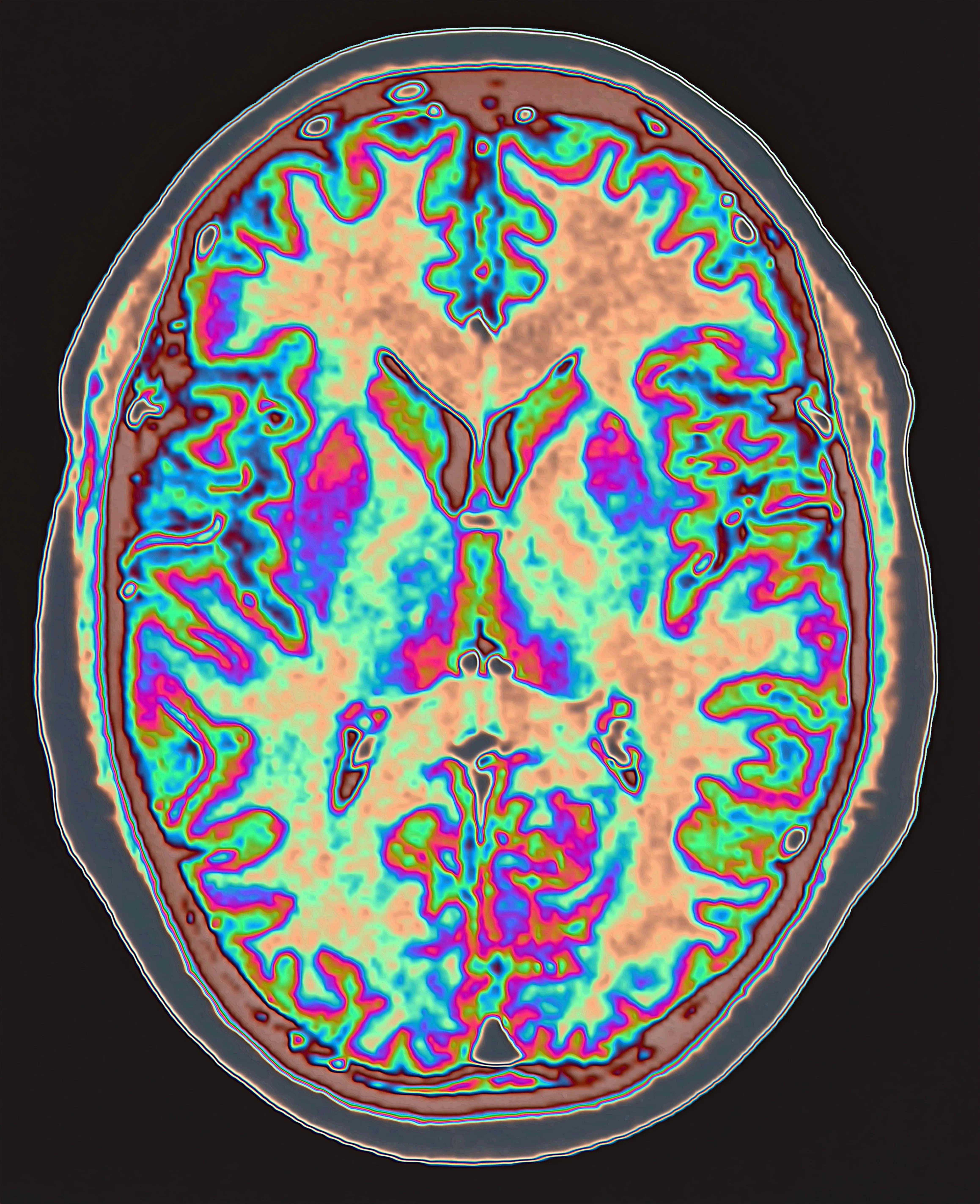 A common side effect of sports could drastically alter the brain