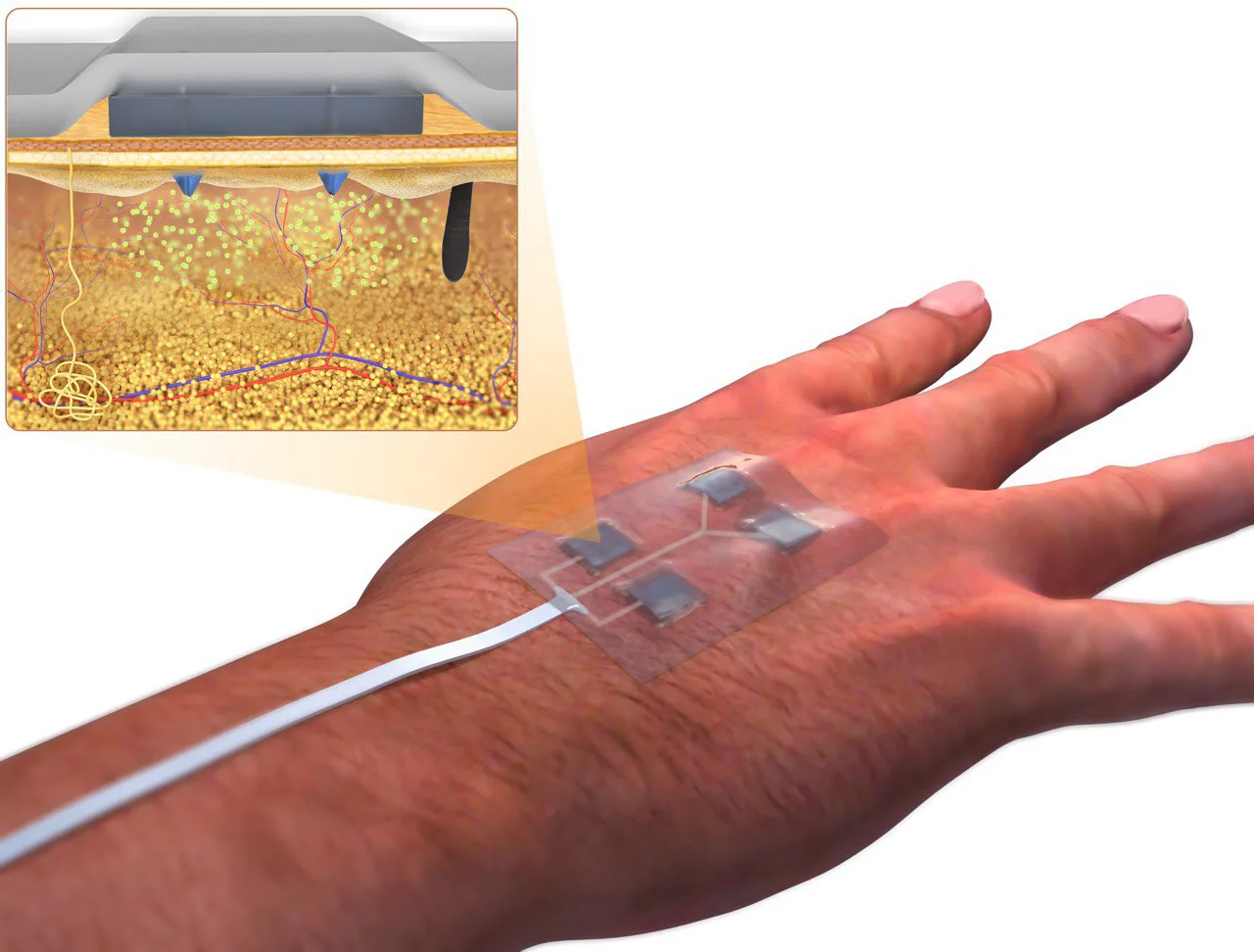 Researchers created a 'smart bandage' to heal wounds that won't heal