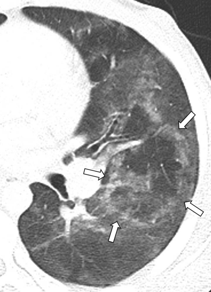 EVALI: 3 shocking images reveal the damage vaping can do to teen lungs