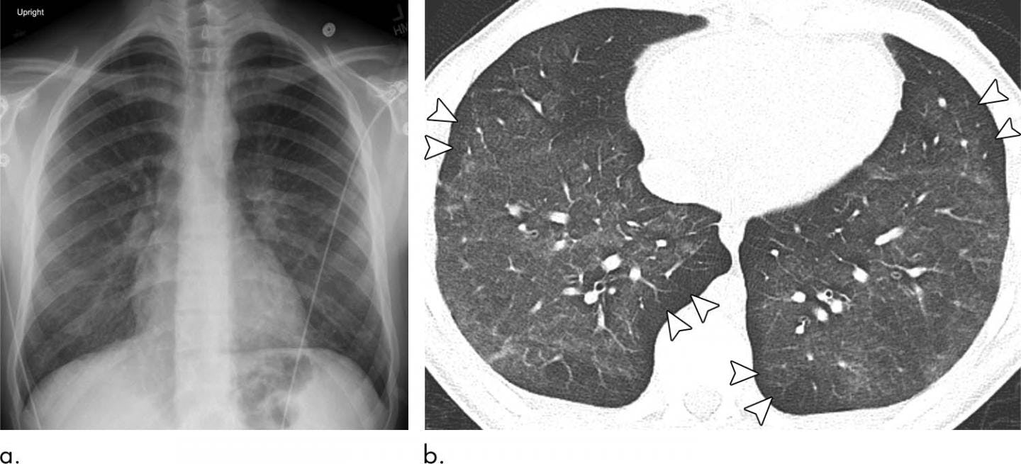 EVALI: 3 shocking images reveal the damage vaping can do to teen lungs