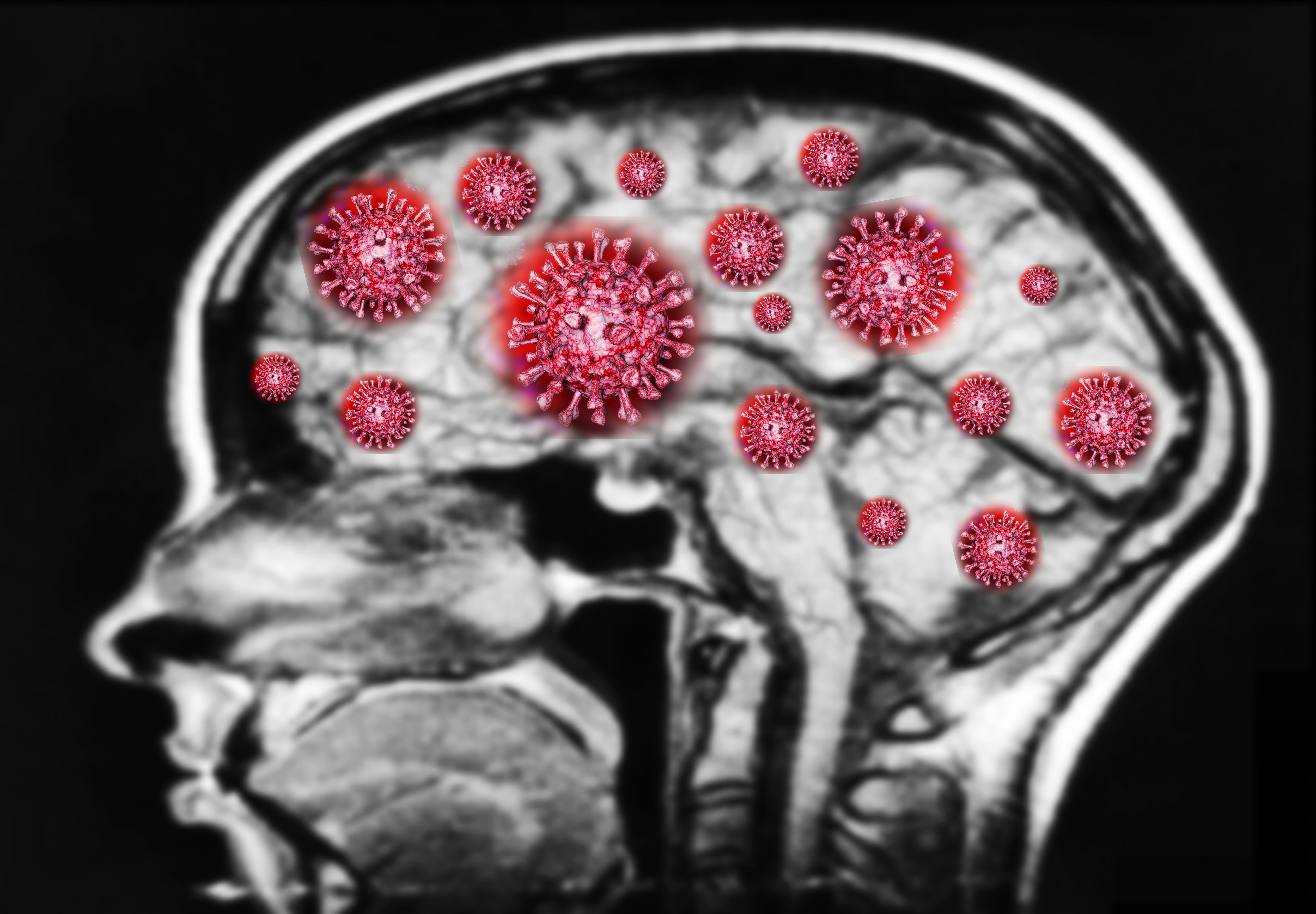 Covid-19 & the brain: Study reveals unique damage caused by the coronavirus