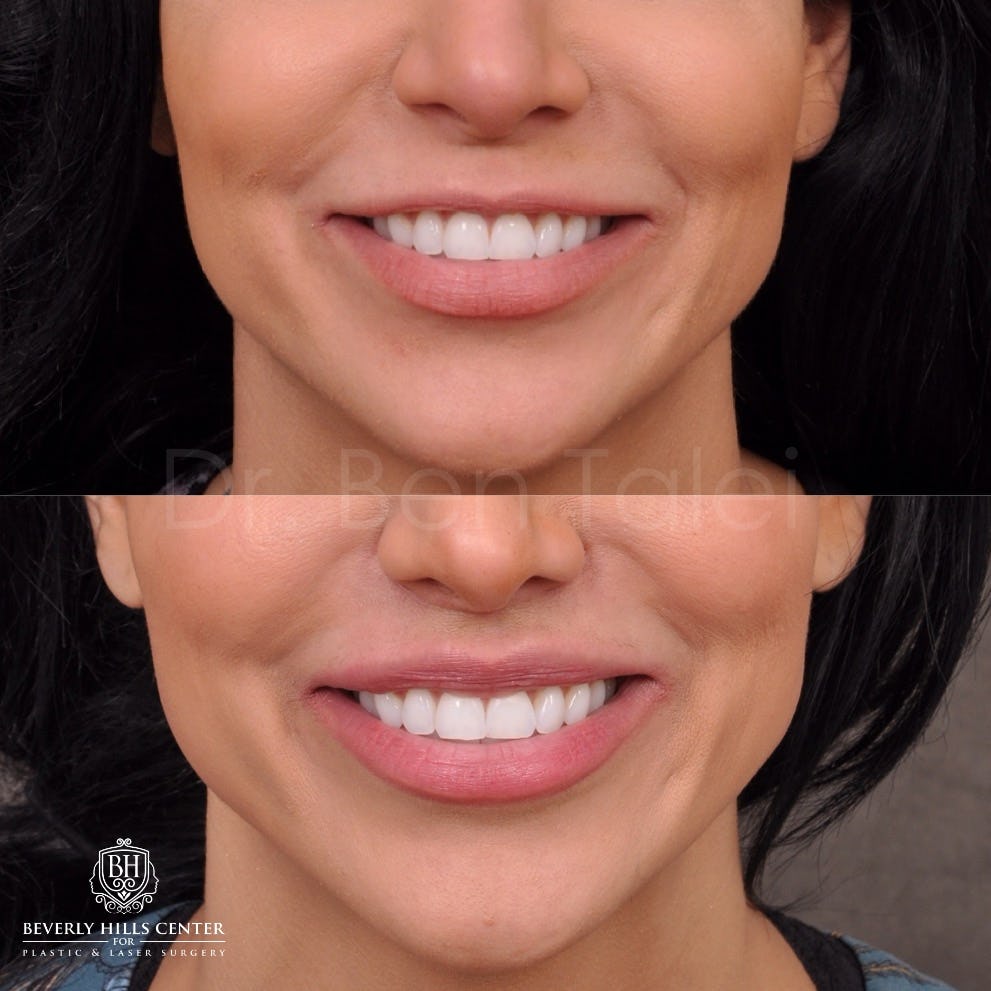 How A Lip Lift Can Help You Achieve A Fuller Pout, Without Fillers