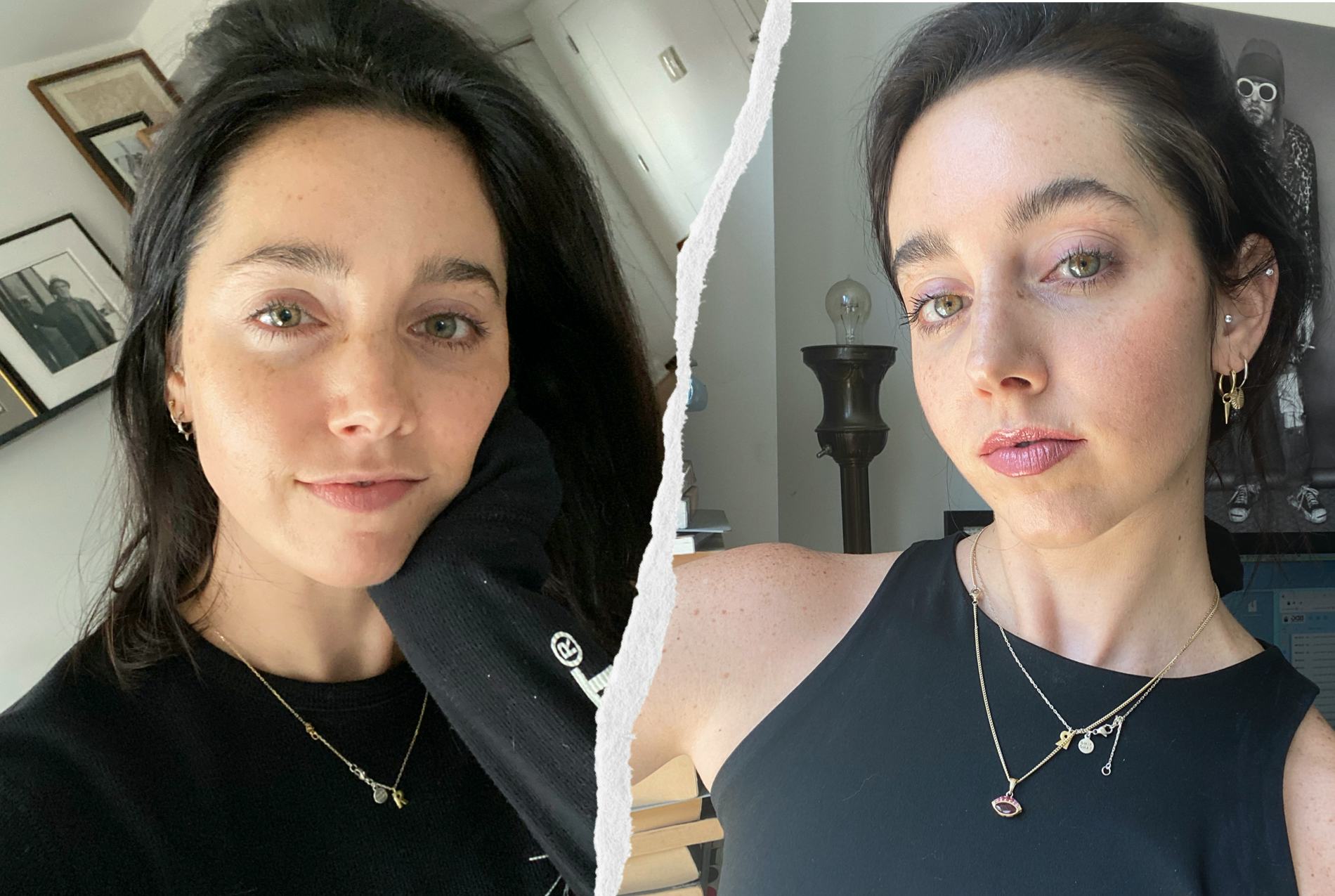 Lip Flip Botox Treatment Review: Here's How It Transformed My Pout