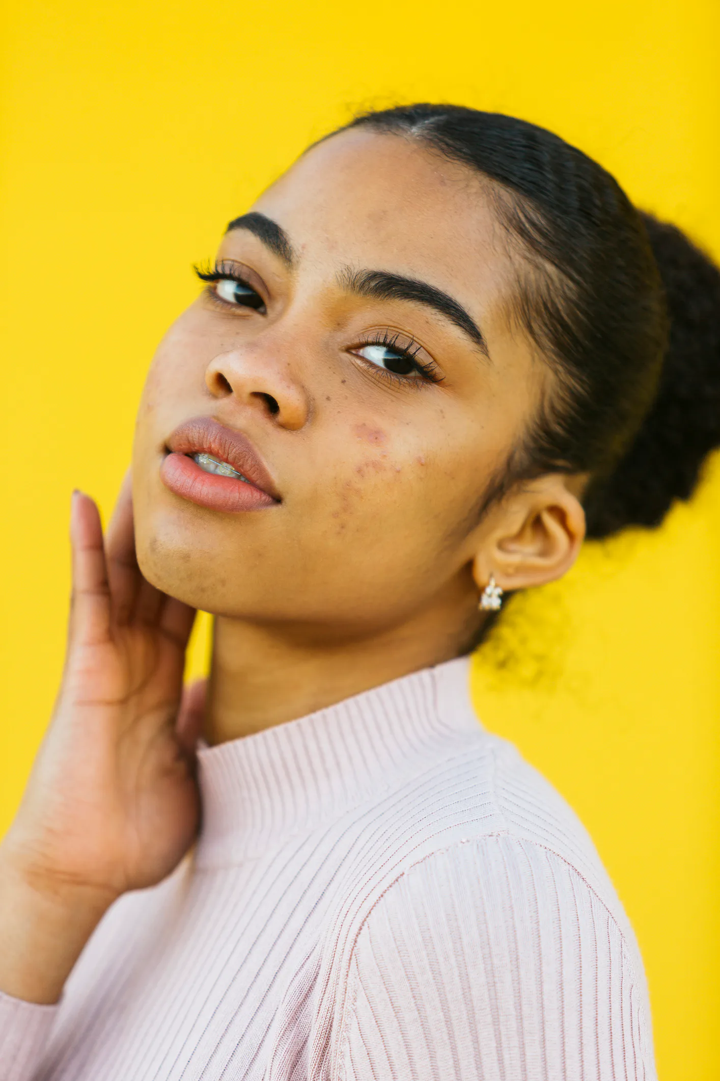 How To Get Rid Of Pitted Acne Scars, According To Dermatologists