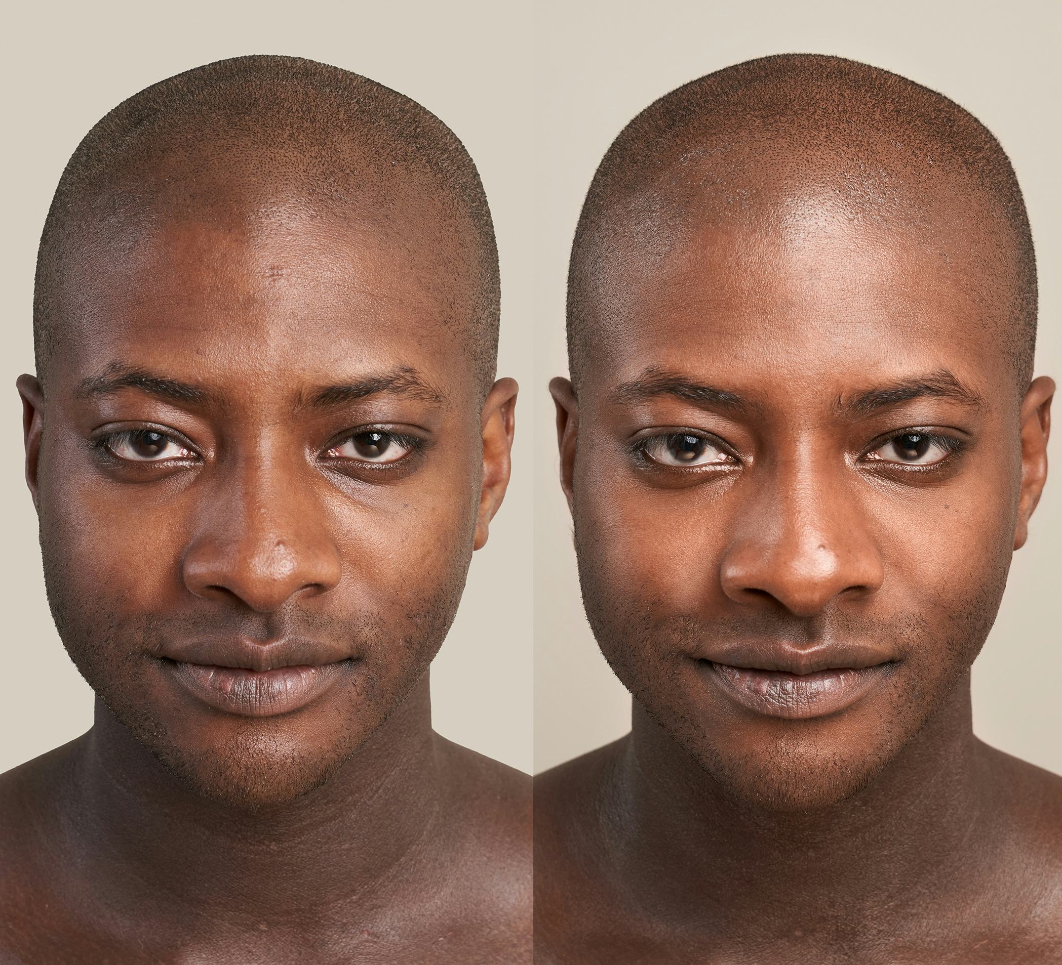 Cold Laser Therapy: Skin Benefits, Cost, & Who Should Seek it Out