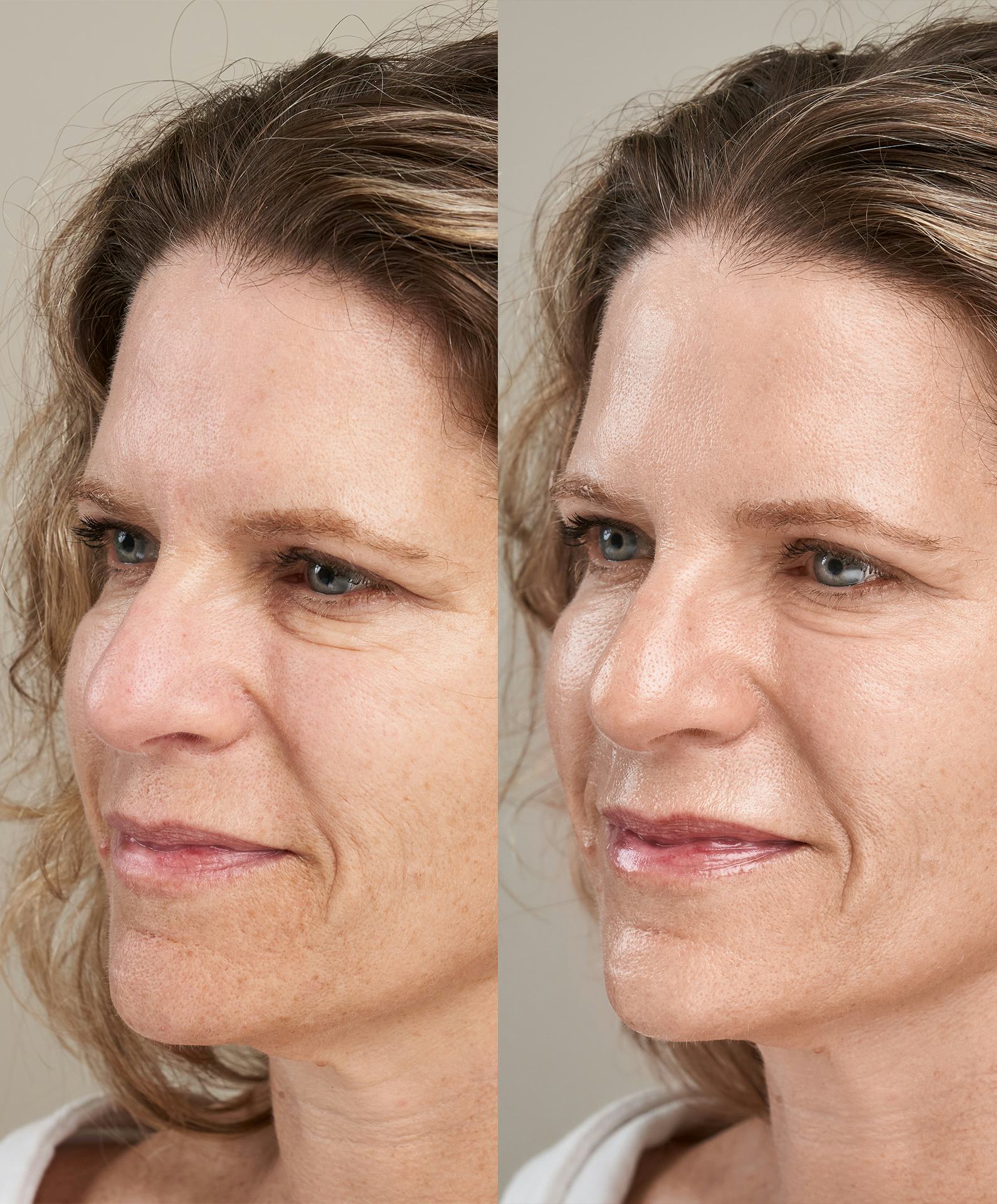 Cold Laser Therapy: Skin Benefits, Cost, & Who Should Seek it Out