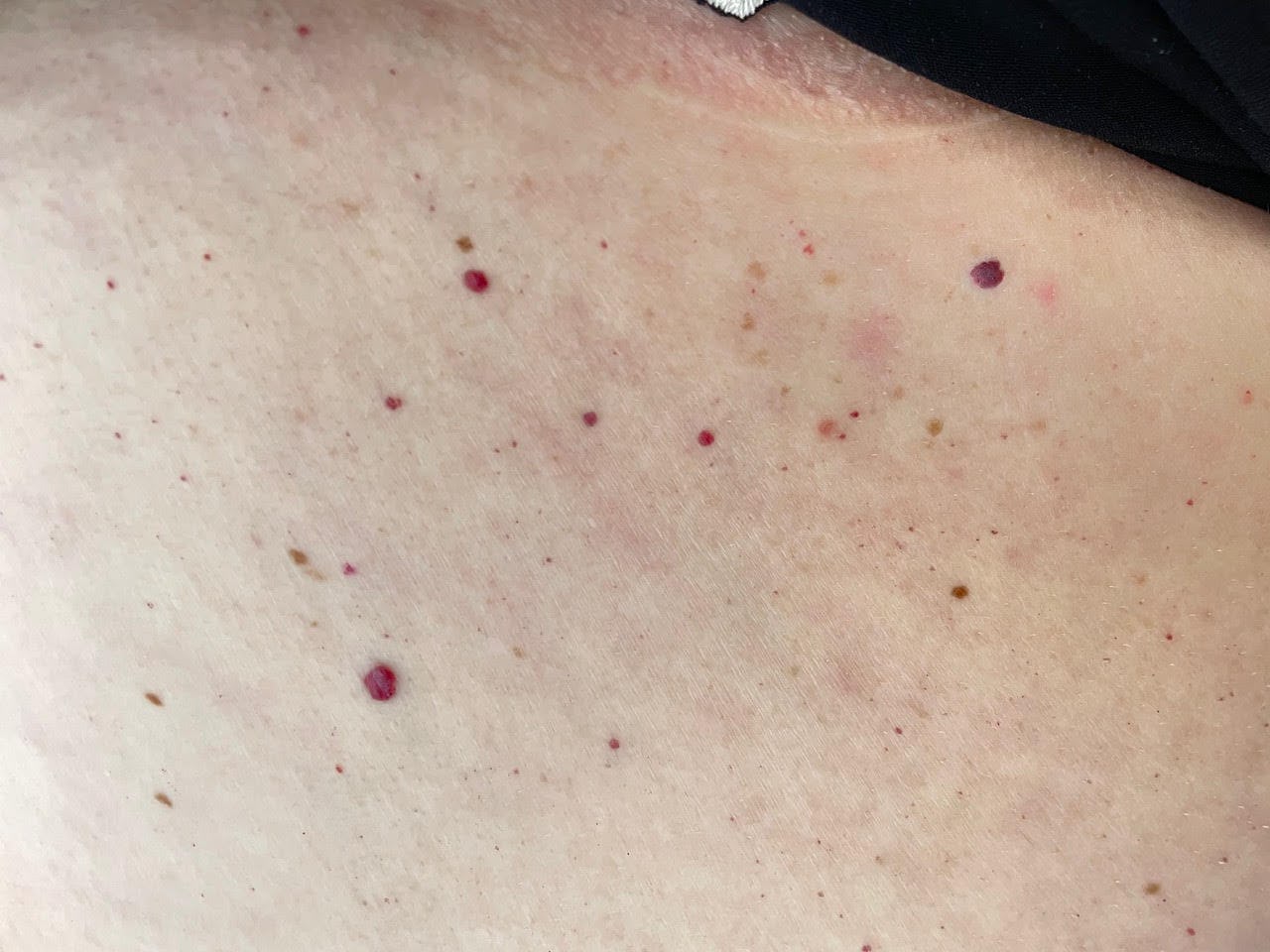 What Causes Cherry Angiomas On Skin & The Best Treatments To Try