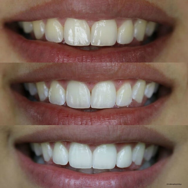 My Teeth Got The A-List Treatment With Smile Brilliant's Whitening System