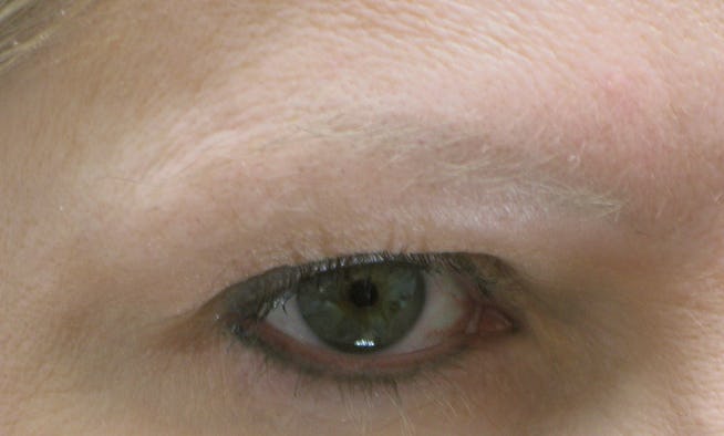An Eyebrow Transplant Can Bring Thin, Sparse Brows Back To Life