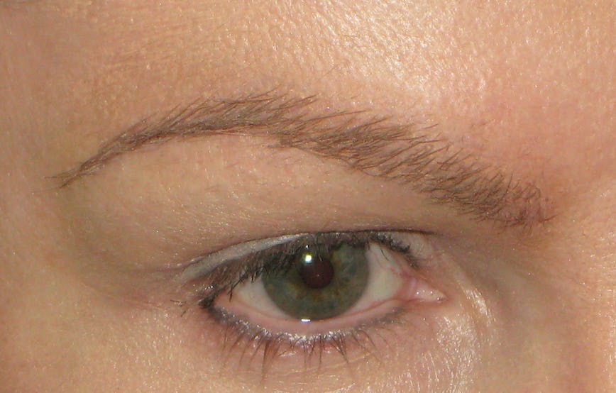 An Eyebrow Transplant Can Bring Thin, Sparse Brows Back To Life