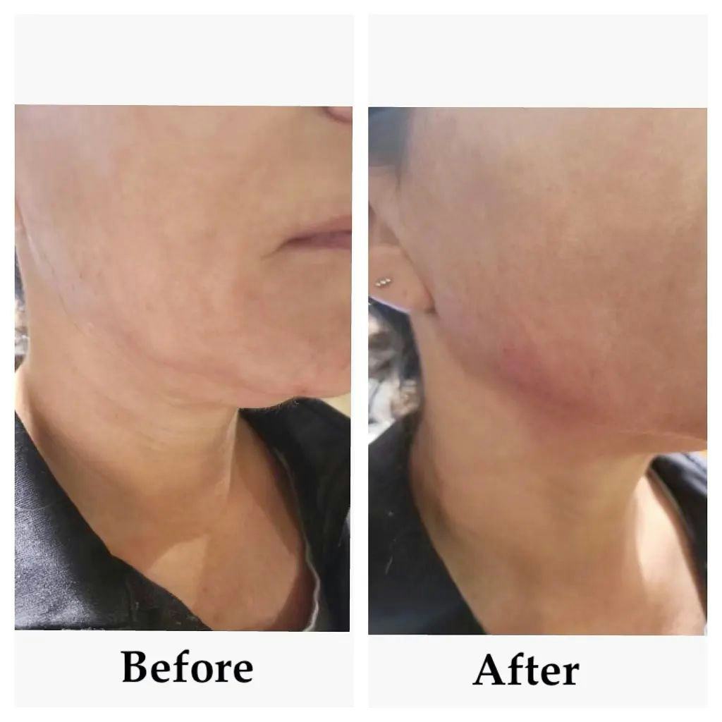Meet Volux — The New FDA-Approved Filler That Sculpts Chiseled Jawlines