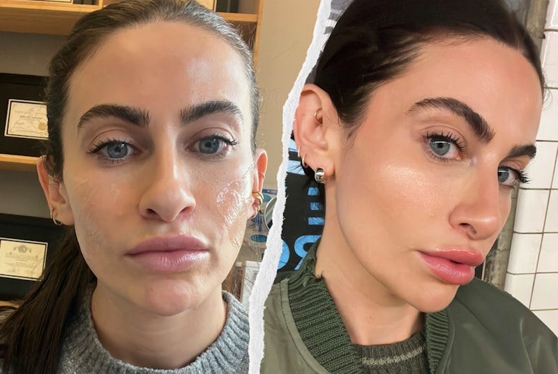 I Tried Skinvive, The Injectable Moisturizer That Smooths The Skin