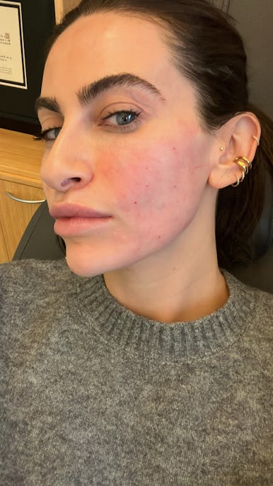 I Tried Skinvive, The Injectable Moisturizer That Smooths The Skin