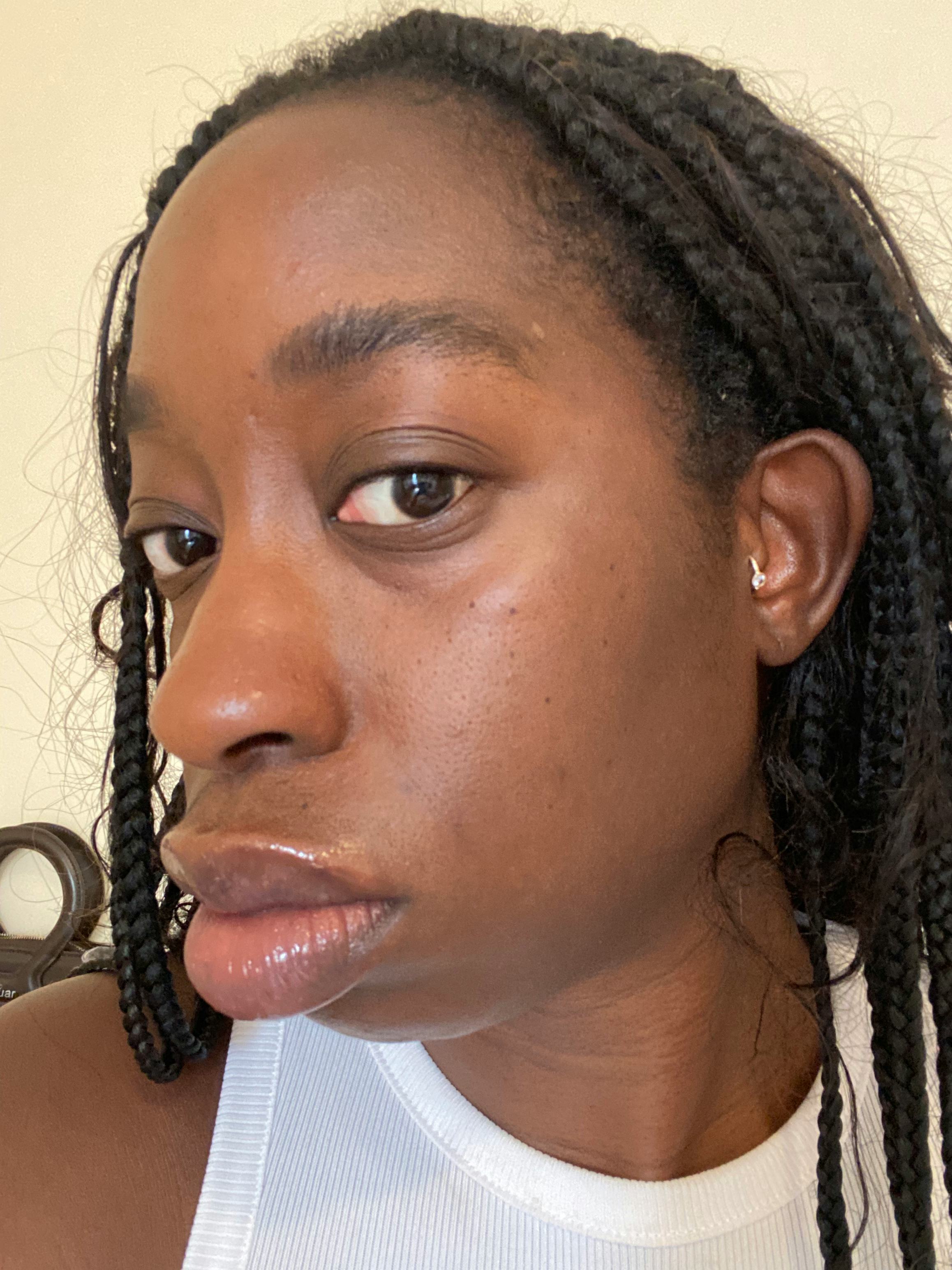 Moxi Laser Review: Before & After Photos, Benefits, & Cost