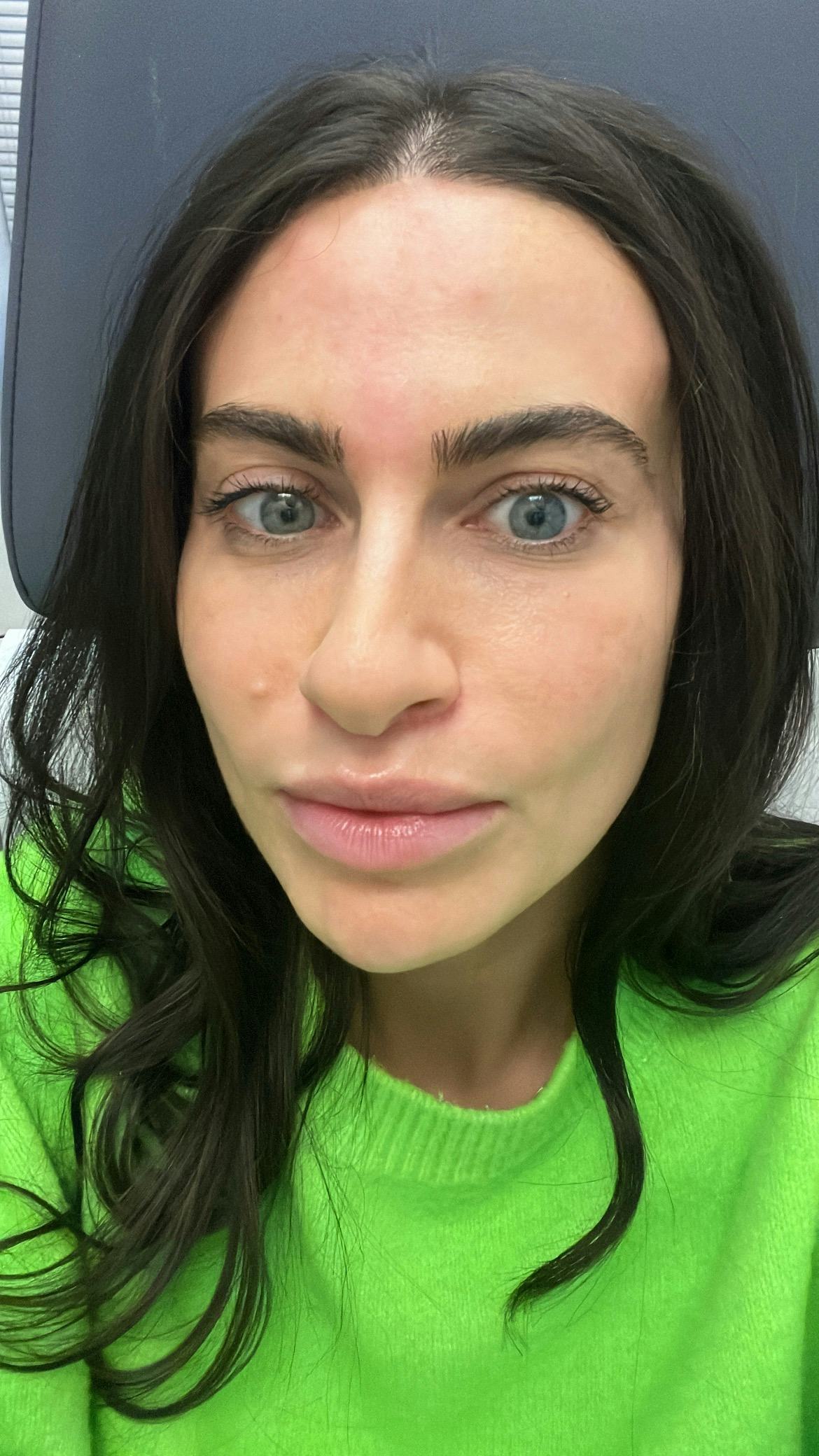 Daxxify Is The Longer-Lasting Botox Alternative You Need To Know