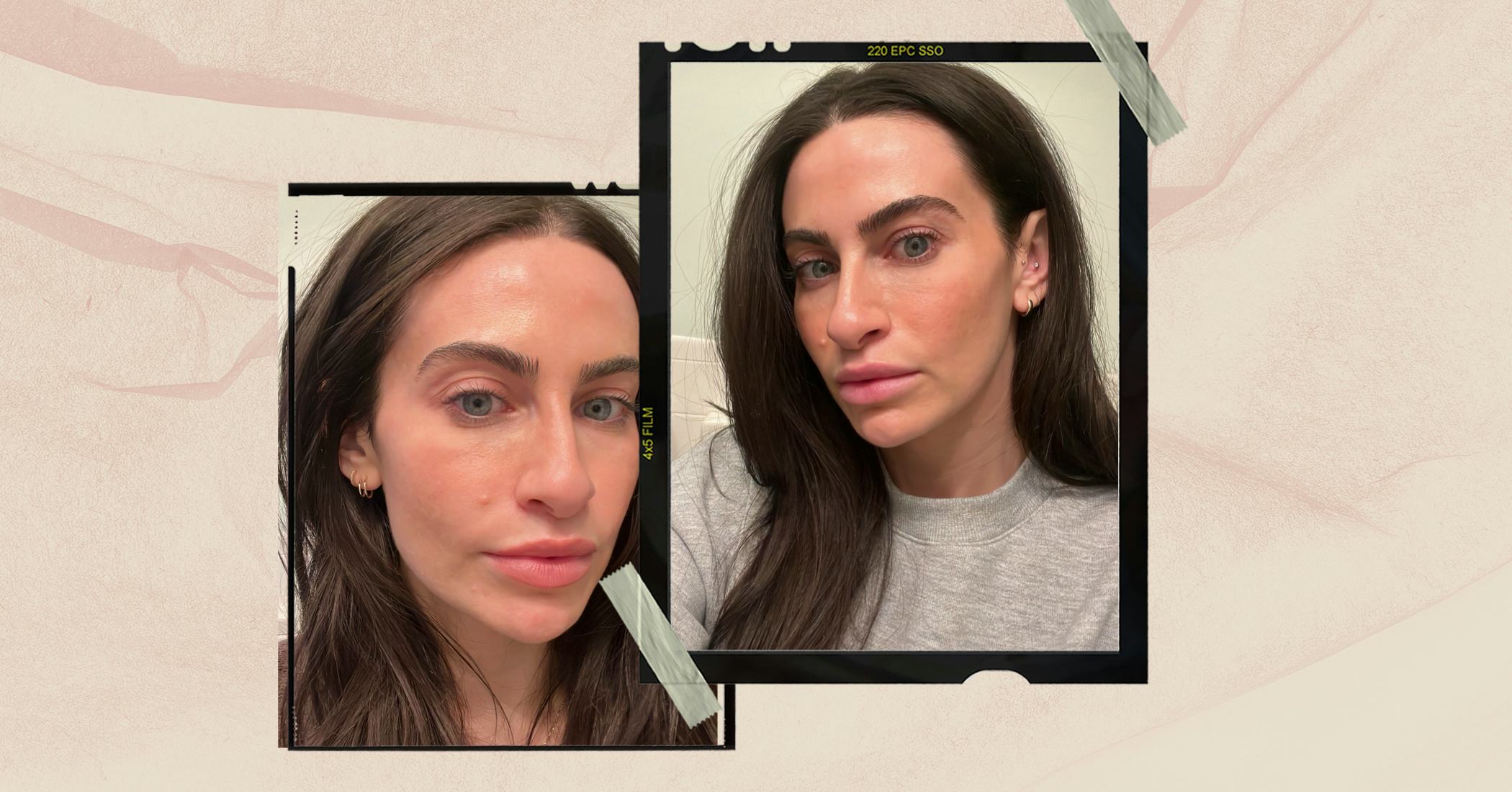 Daxxify Is The Longer-Lasting Botox Alternative You Need To Know