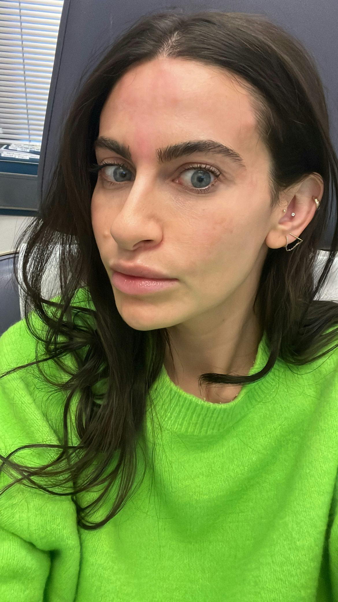 Daxxify Is The Longer-Lasting Botox Alternative You Need To Know